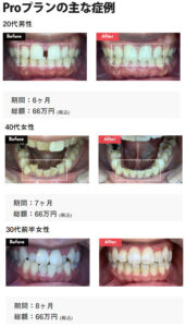 Oh my teeth(オーマイティース)の口コミや効果を調査！失敗や後戻りしないための注意点と選び方